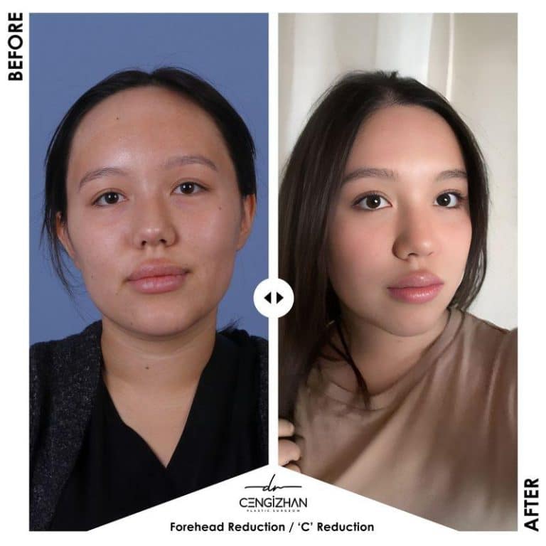 Forehead Reduction Surgery in Turkey: Why More Patients Trust Dr ...