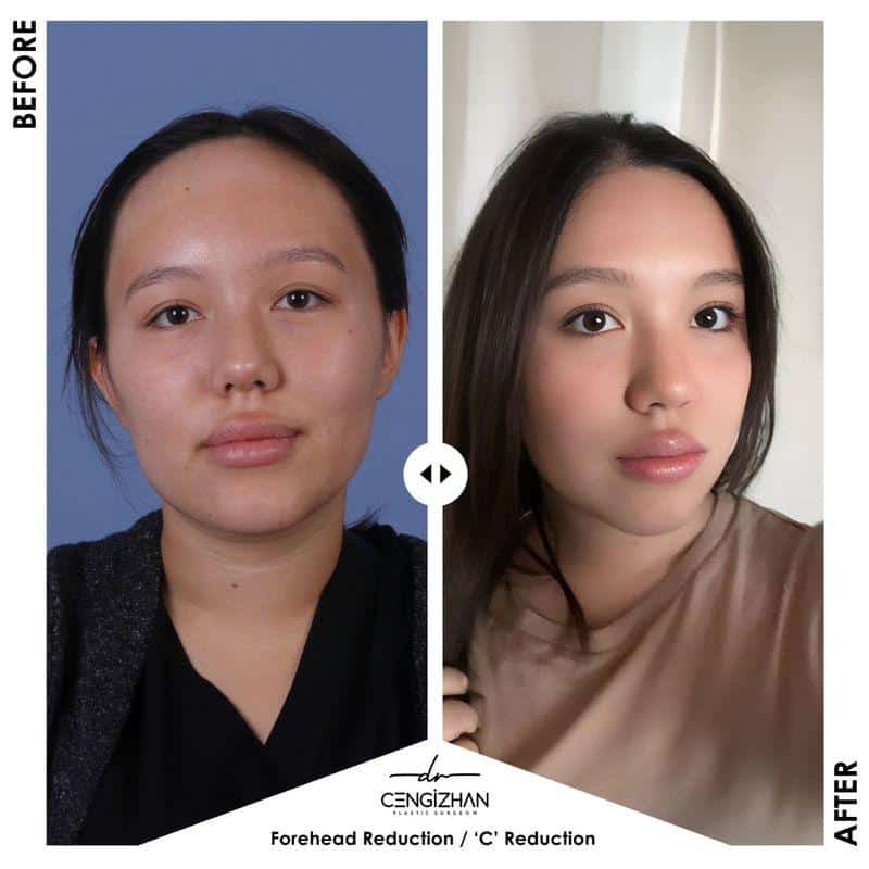 Forehead Reduction Surgery in Turkey: Why More Patients Trust Dr ...